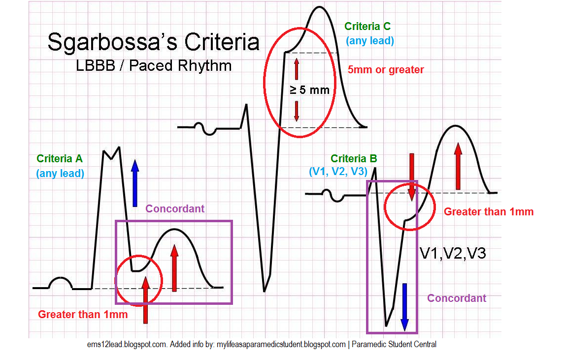 Paramedic Student Central: Sgarbossa’s Criteria