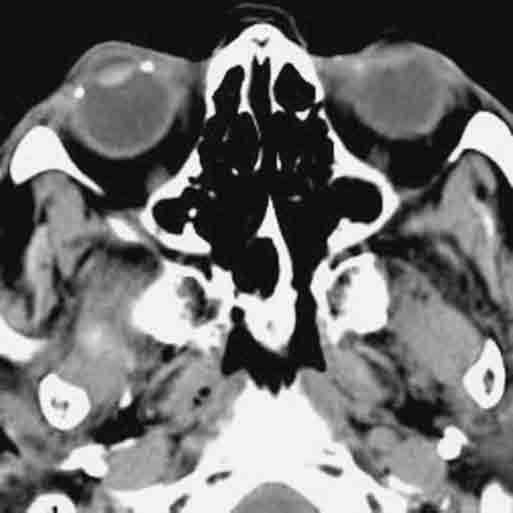 Ct Of Scleral Plaques