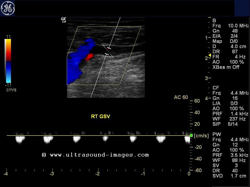 cochinblogs: Ultrasound imaging of popliteal vein thrombosis