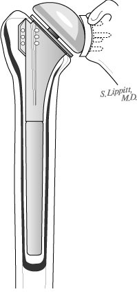 UW Shoulder and Elbow Academy: Revision surgery for failed shoulder ...