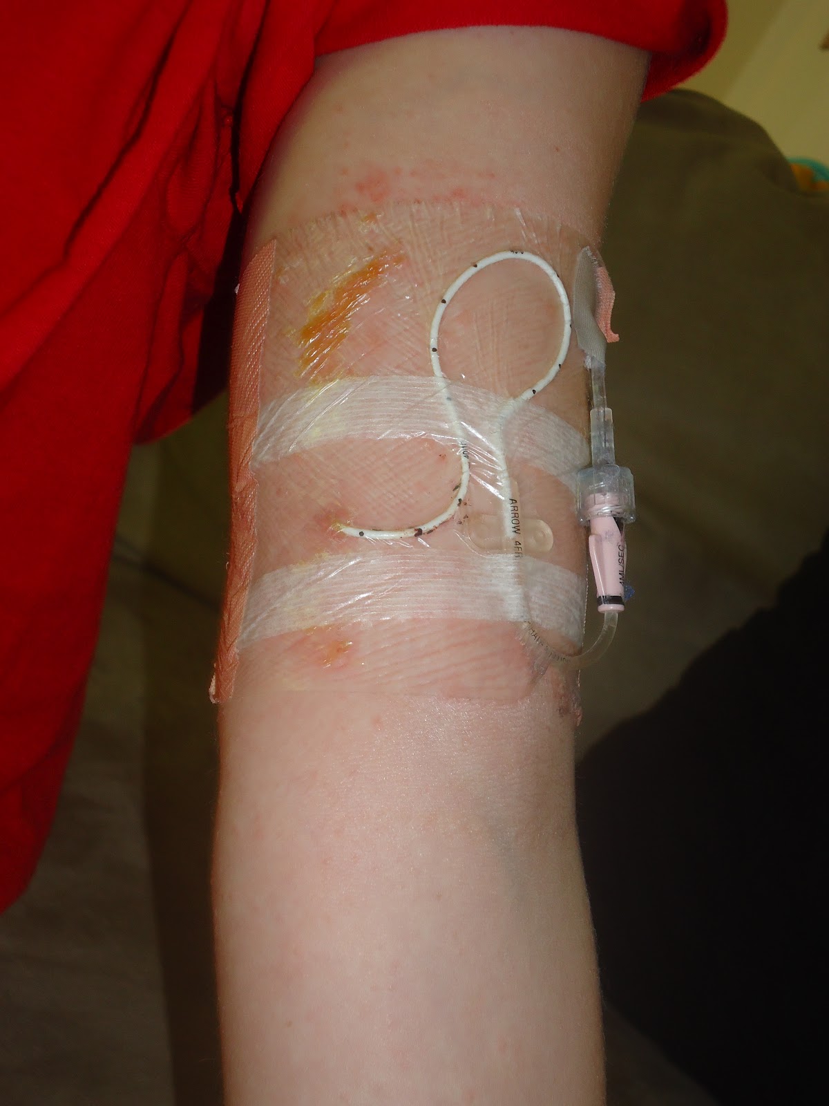 A Day in the Lyme Life: The PICC Line