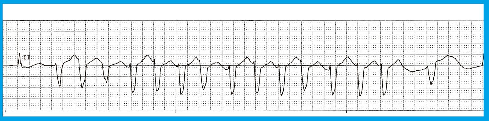 Various Ventricular Tachycardias