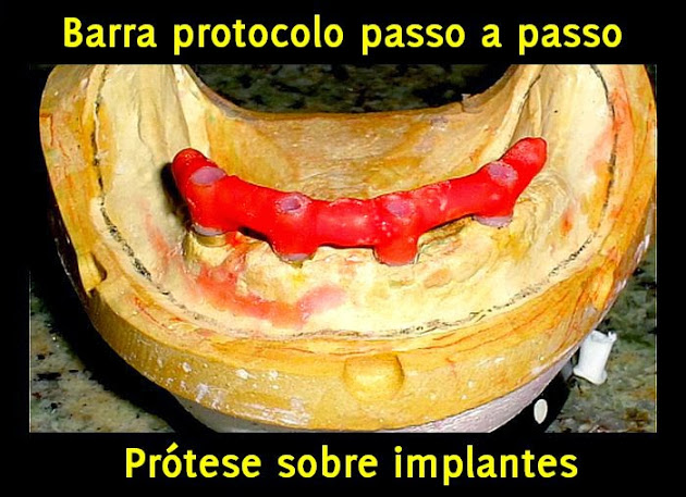 IMPLANTODONTIA: Barra protocolo passo a passo