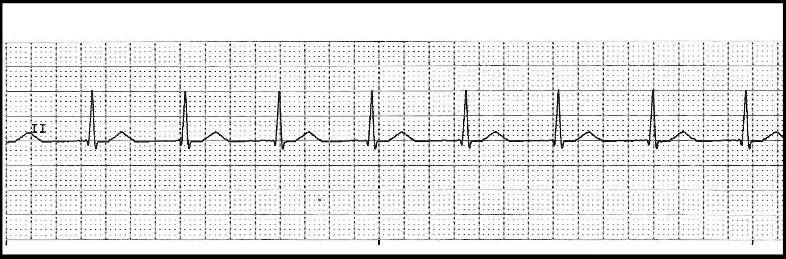 Basic EKG Test 63