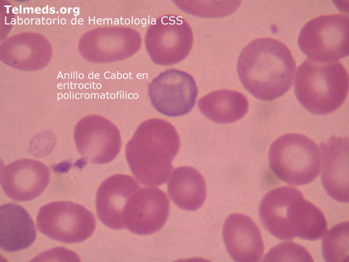 Hematología: Anormalidades Eritrocitarias