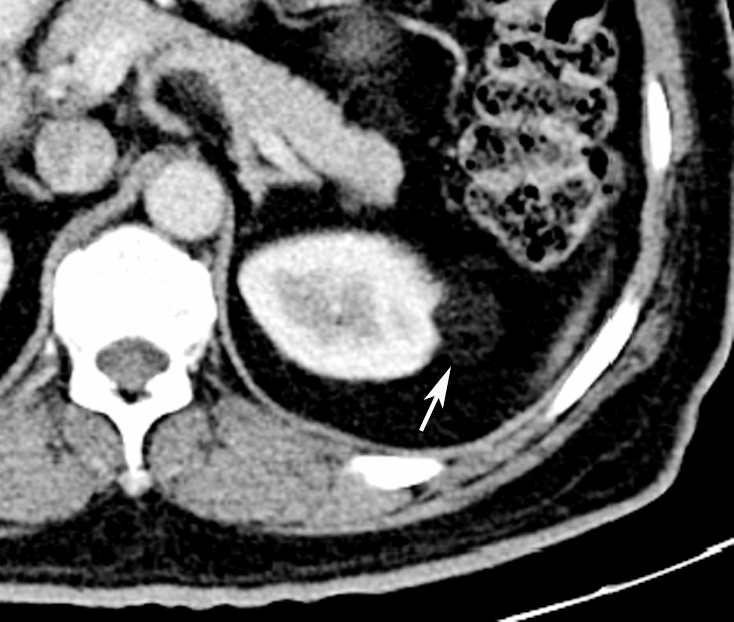 Radiodiagnosis - Imaging is Amazing-Interesting cases: Renal ...