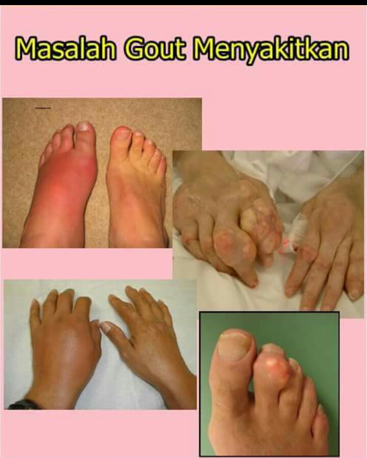 ERAT KASIH SDN BHD OFFICIAL (1124827P) : APA ITU GOUT DAN SIMPTOM2NYA ...