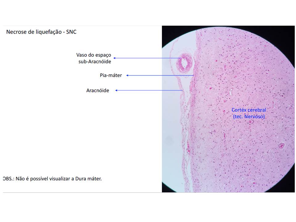 HISTOLOGIA90: TIPOS DE NECROSE
