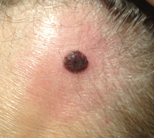 Photos of Moles on Face and Neck ~ How To Remove Moles, Warts, Skin ...