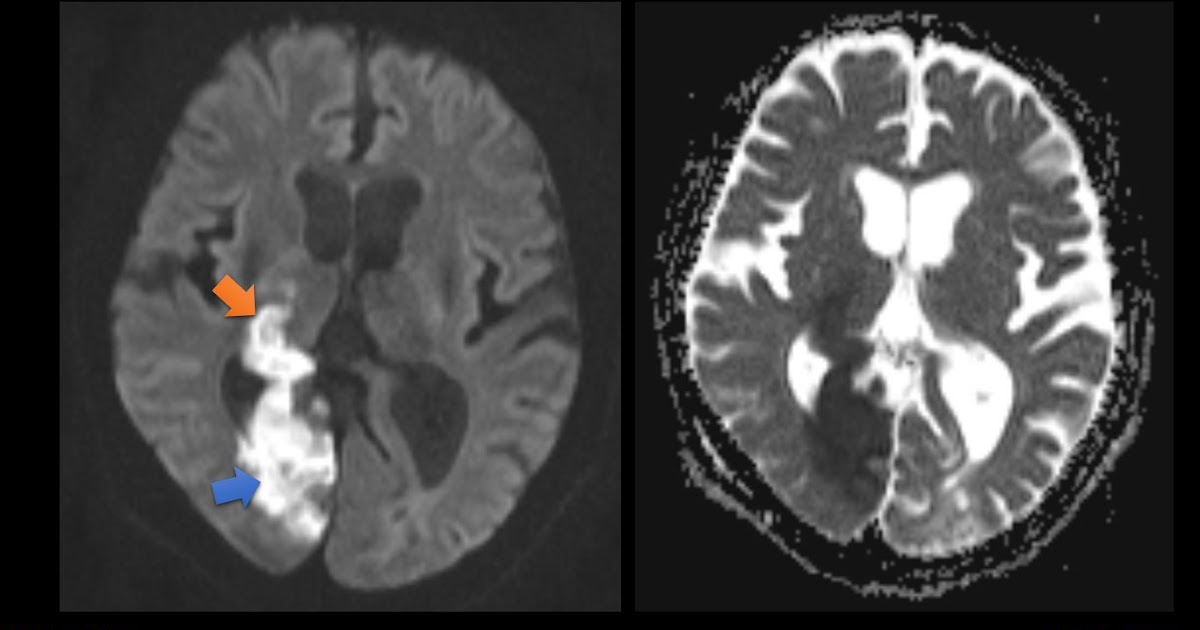 Ultimate Radiology : Acute PCA territory infarct