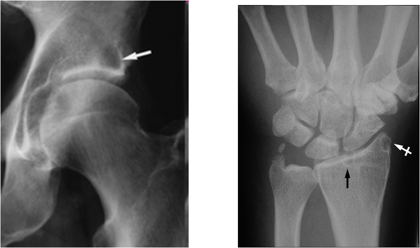 Dentistry and Medicine: Osteoarthritis