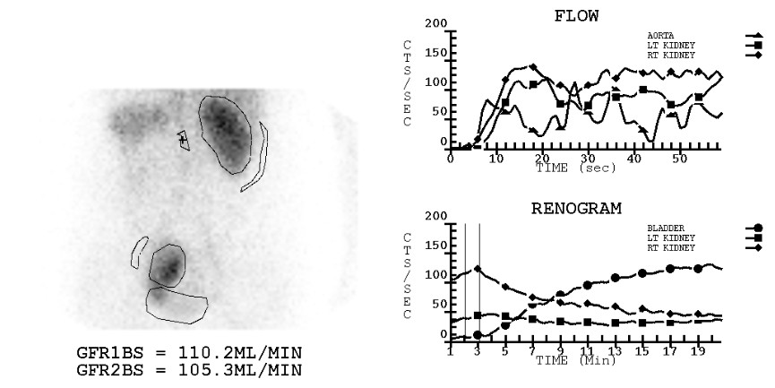 NuCleaR MuNkeE: Split Renal Function in a Pelvic Kidney