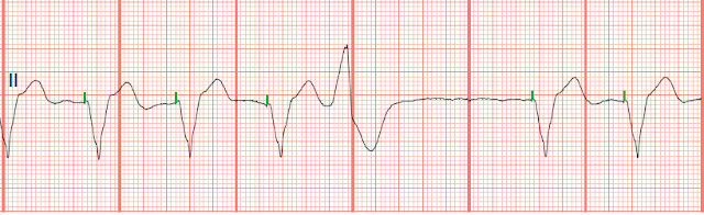 Basic EKG Rhythm Test 46