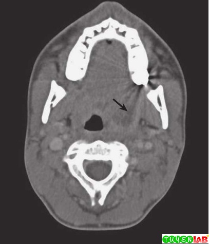 [Pediatric] Atlas of Acute Upper airway obstruction | Free Medical Atlas