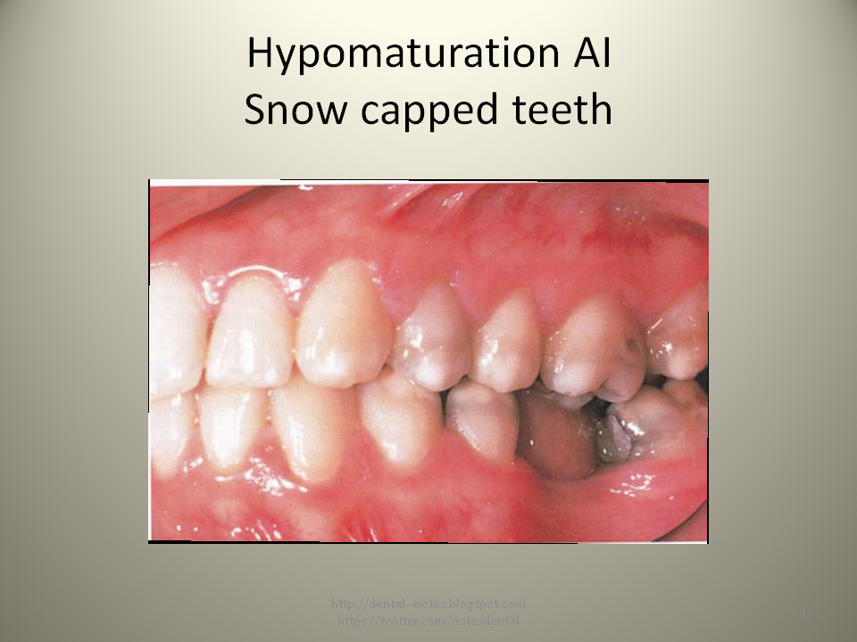 Dental Notes: Amelogenesis Imperfecta NOTES