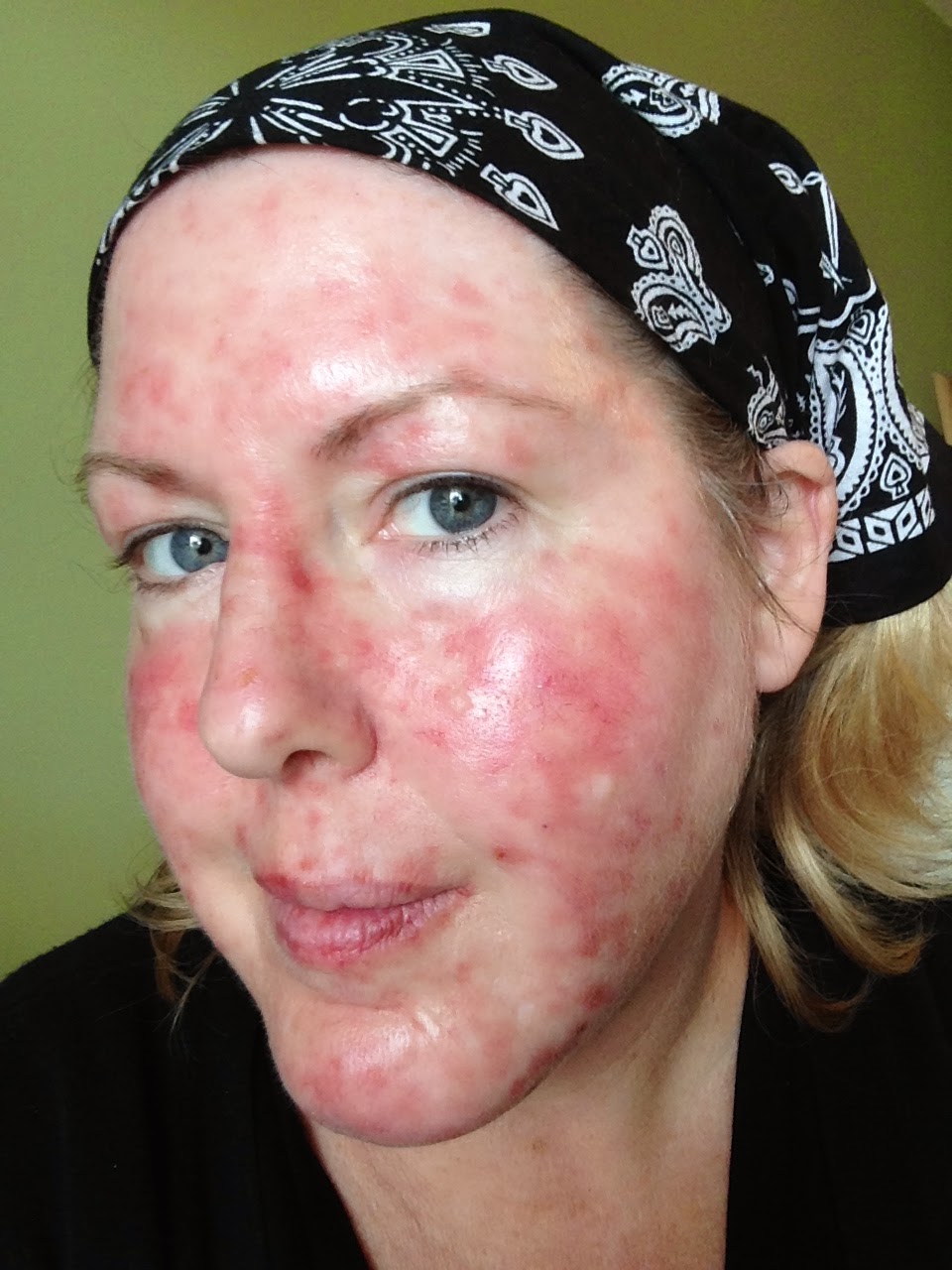 My Journey Through Topical Chemotherapy - Fluorouracil 5% Cream and ...