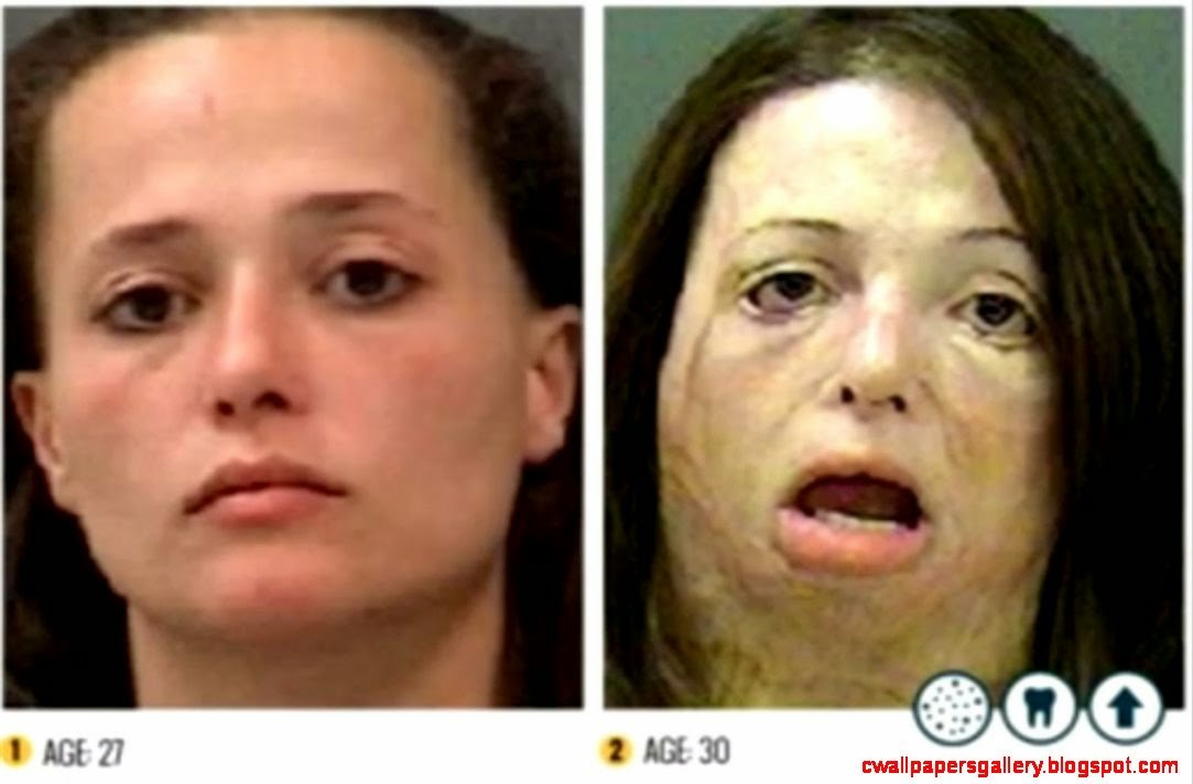 Crystal Meth Before And After | Wallpapers Gallery