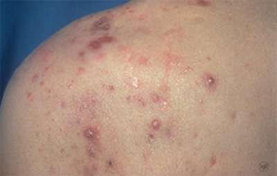 Shoulder Acne - Tips too reduce of the shoulder acne - Shoulder Acne