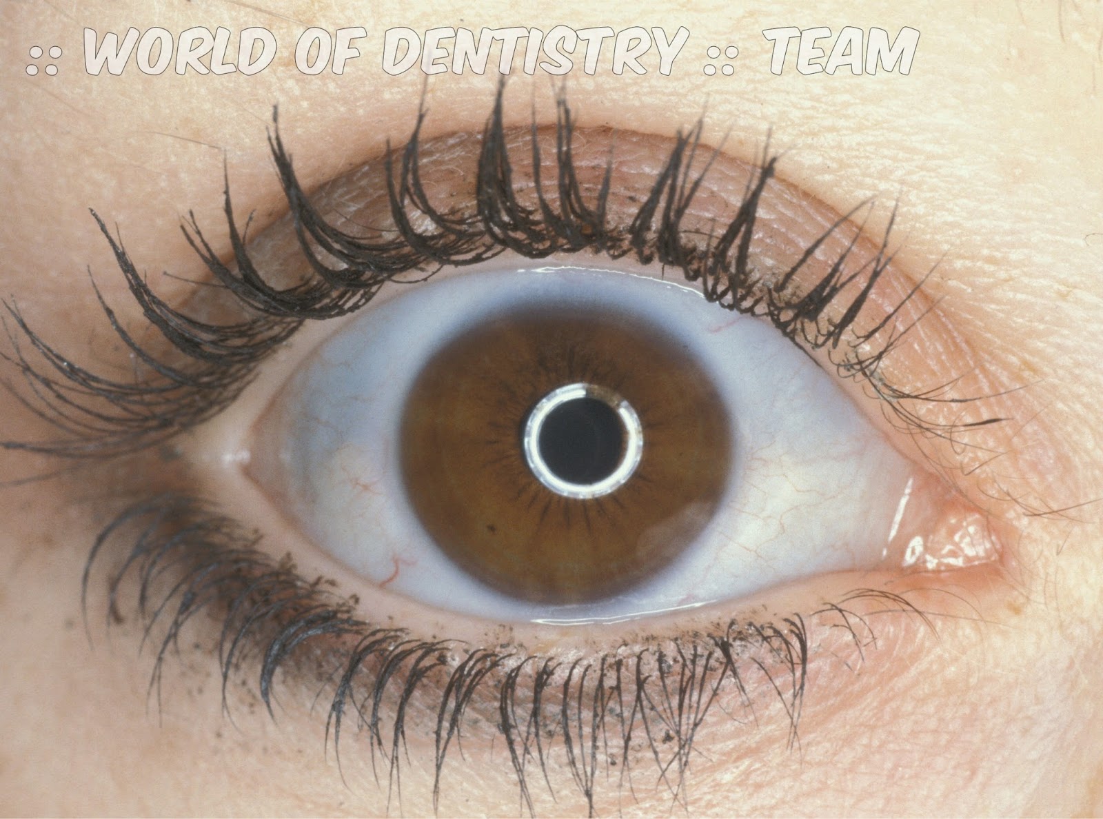 :: World Of Dentistry ::: Blue Sclera "Definition and Diseases"