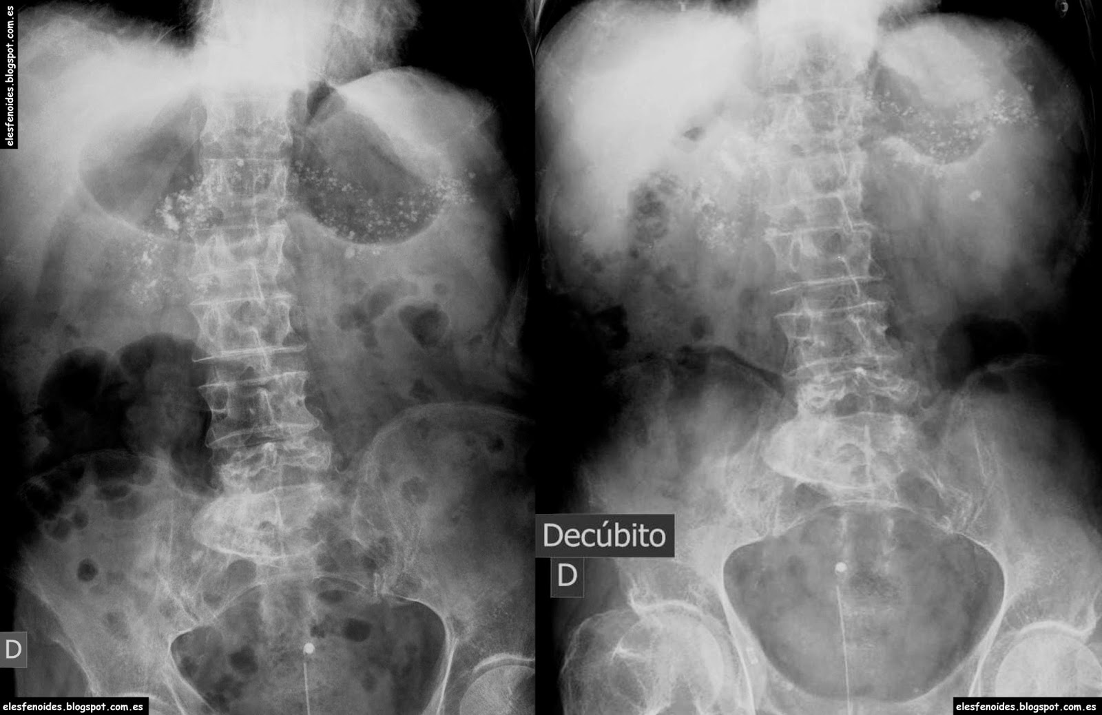 El esfenoides: Calcificaciones pancreáticas. 2 imágenes 1 caso.