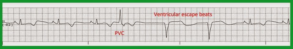 Practice Rhythm Strips 299