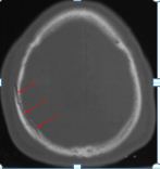 Dr Herry Setya Yudha Utama SpB. FInaCS. MHKes. ICS: Seri Bedah Saraf ...