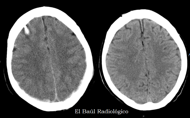 El Baúl Radiológico: 2) EDEMA CITOTÓXICO EN EL SISTEMA NERVIOSO CENTRAL ...