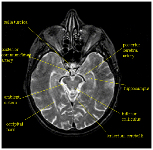 Basal cisterns | Brain Interactive