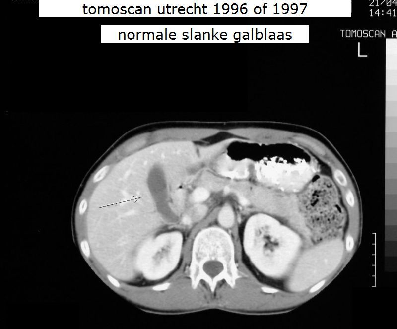 hourglass gallbladder