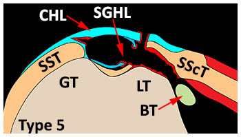 MRI Musculo-Skeletal Section: Long head of biceps dislocation grading.