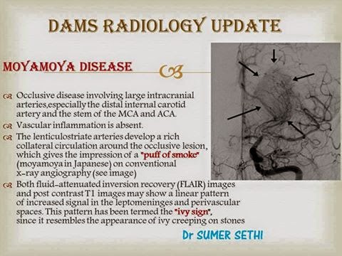 Moya Moya Disease - Sumer's Radiology Blog