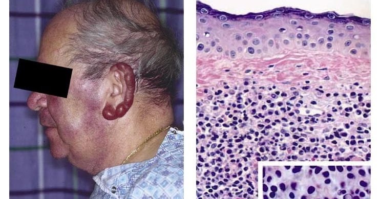 New Treatment for Waldenstrom's Macroglobulinemia