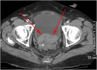 Radiologist For Ever: Male pelvis rule14 : Cystitis