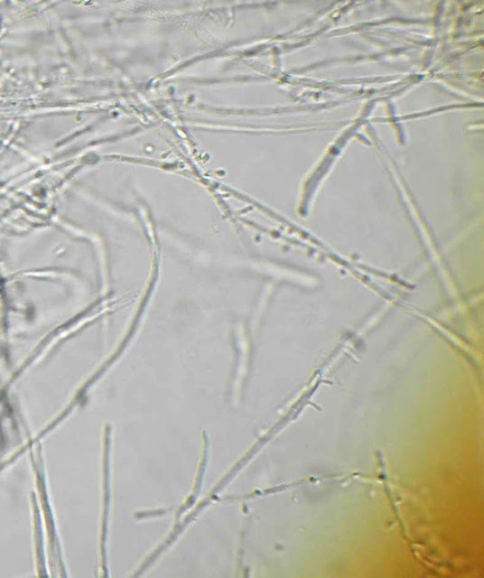 ATLAS MICOLOGIA: TRICHOPHYTON TONSURANS