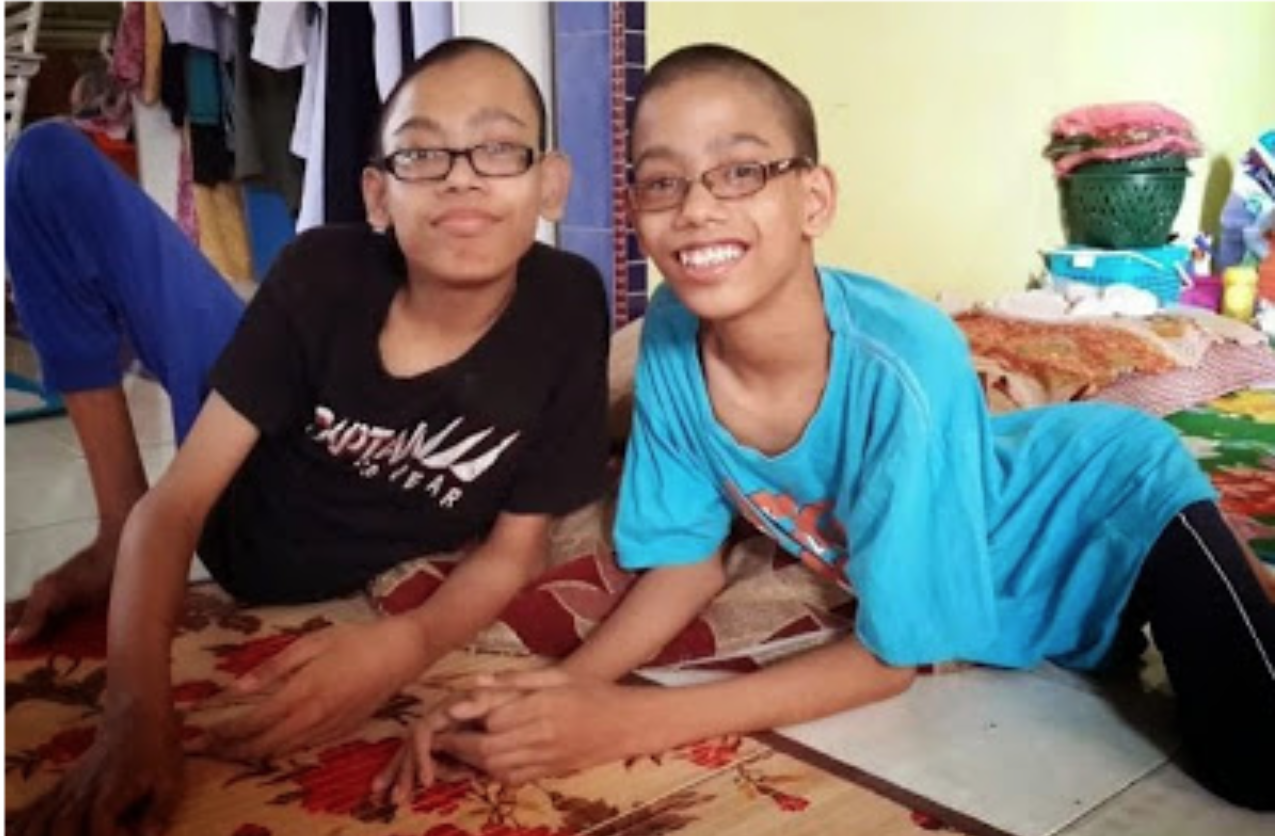 JOM TENGOK GAMBAR !! Gambar Kembar Siam Ahmad dan Muhammad Selepas 17 ...