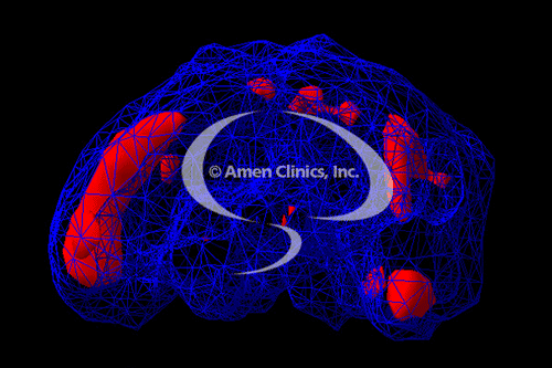 Dyslexia and Irlen Syndrome: Irlen Syndrome - Dyslexia and brain scans