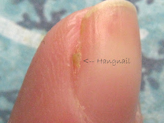 Rehab Your Nails: What's a hangnail? - Bee Polished