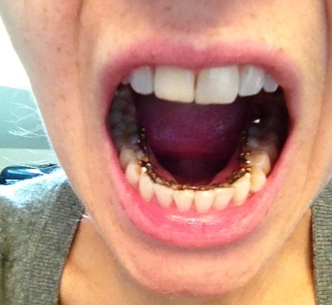 B's Beauty Blog: Incognito braces - train tracks for adults!