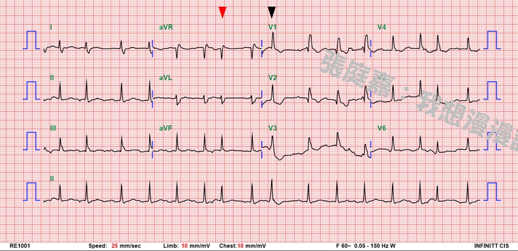 傻傻分不清楚：VPC還是APC？