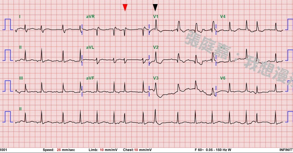 傻傻分不清楚：VPC還是APC？