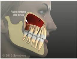 OROANTRAL FISTULA - Isna Mei Iriyana Dewi