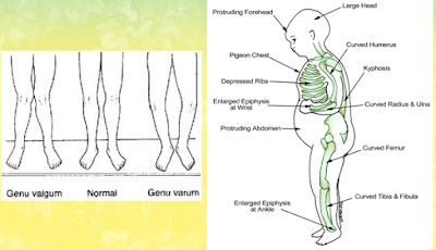 KNOWLEDGE: OSTEOMALASIA DAN RAKITIS