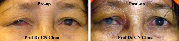 Eyelid Surgery by Prof Dr CN CHUA 蔡鐘能: Pain and Visual Loss from ...