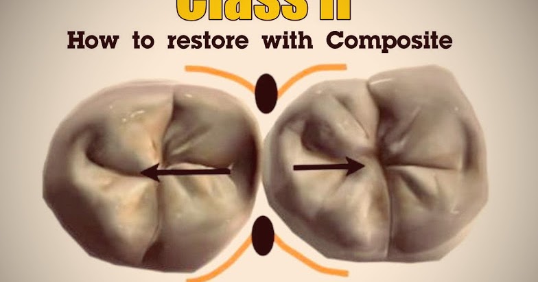 COMPOSITE RESTORATION: How to restore the difficult Class II with ...