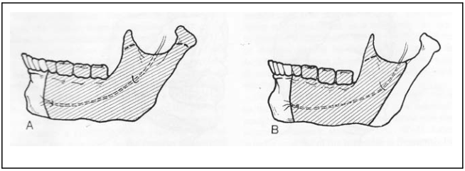Ameloblastoma Adalah | Dokter Gigi