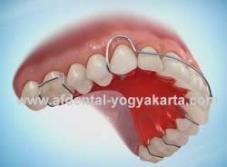 Retainer transparan / invisible di Yogyakarta ~ AF Dental Laboratory ...