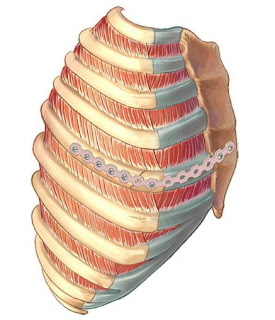 Revision Casos De Cirugia General: TORAX INESTABLE O TORAX FLOTANTE: