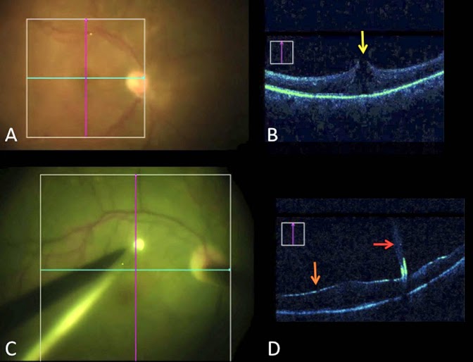 DEGENERACION MACULAR : RESCAN 700
