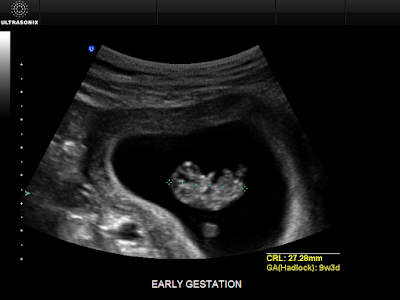 Pemeriksaan Ultrasonografi (USG) Trimrster Pertama