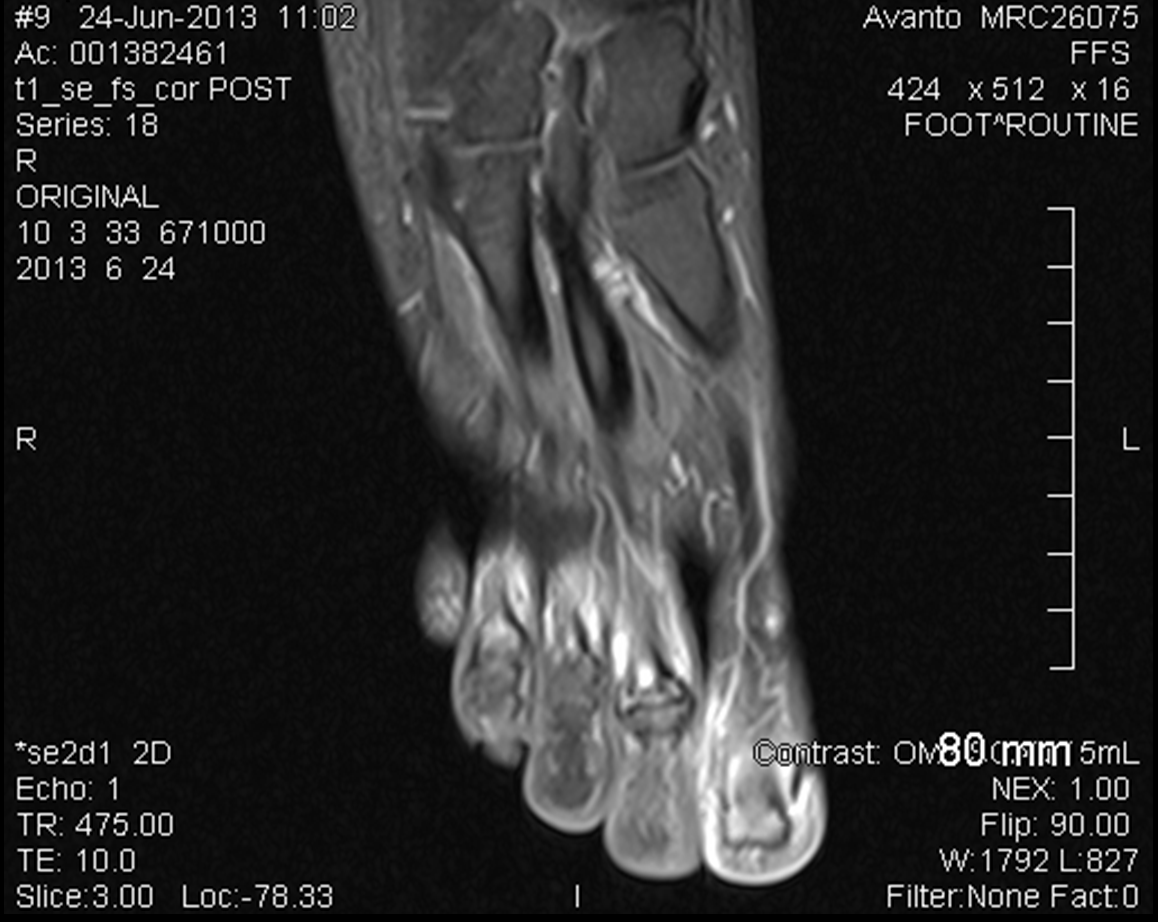 wtf is wrong with my toe???: Toe MRI